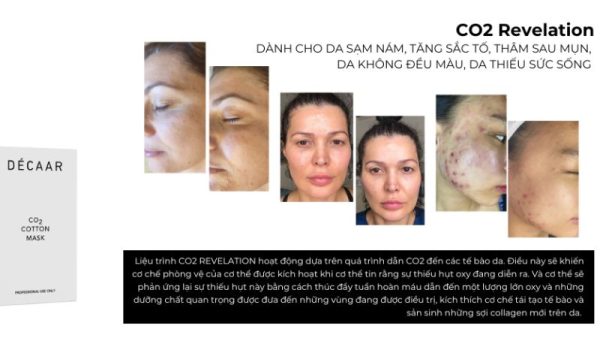 CO2 REVELATION - PHƯƠNG PHÁP ĐIỀU TRỊ DA SẠM, NÁM, THÂM MỤN - Decaar Việt Nam